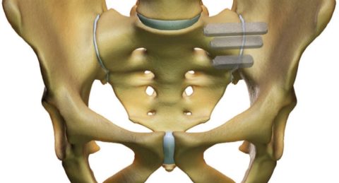 SI-BONE’s iFuse Implant System® Requires Revision Surgery 5 Times Less ...