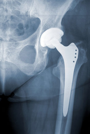 MHRA Updates Alert on Metal-on-Metal Hip Implants – Oasis Surgical