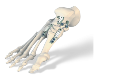 CrossRoads® Extremity Systems, LLC Announces Launch of the DynaFORCE ...