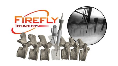 OrthoPediatrics Announces Expanded Indication for FIREFLY® Pedicle ...