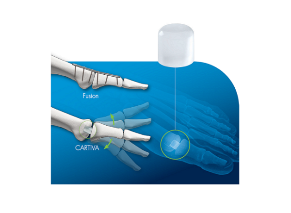 Cartiva Announces Presentation of Long-Term Clinical Data on Treating ...