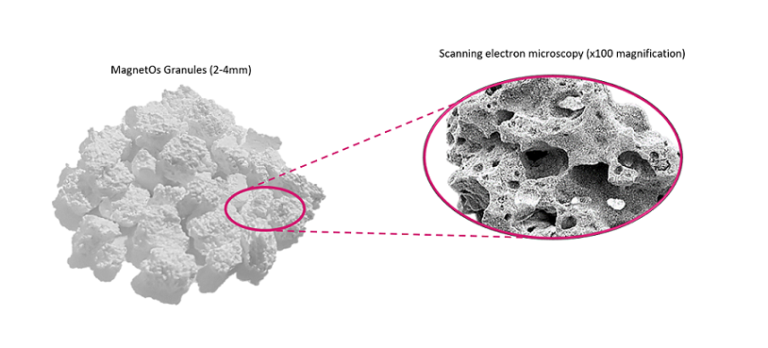 Kuros Biosciences Reports First U.S. & UK sales of MagnetOs – Oasis ...