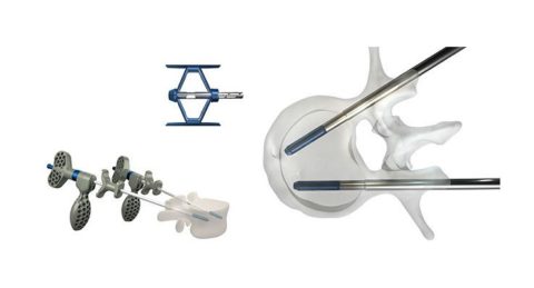 Stryker announces 510(k) clearance of SpineJack® Implantable Fracture ...