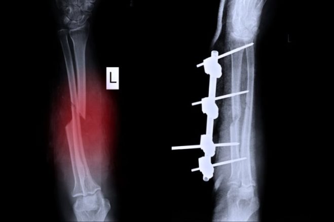 Global $11.4 Bn Orthopedic Trauma Fixation Devices Market to 2023 by ...