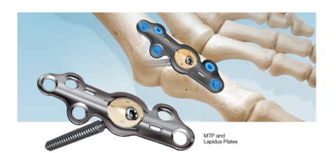 In2Bones Commercializes CoLink® View “See-Through” Plating System ...